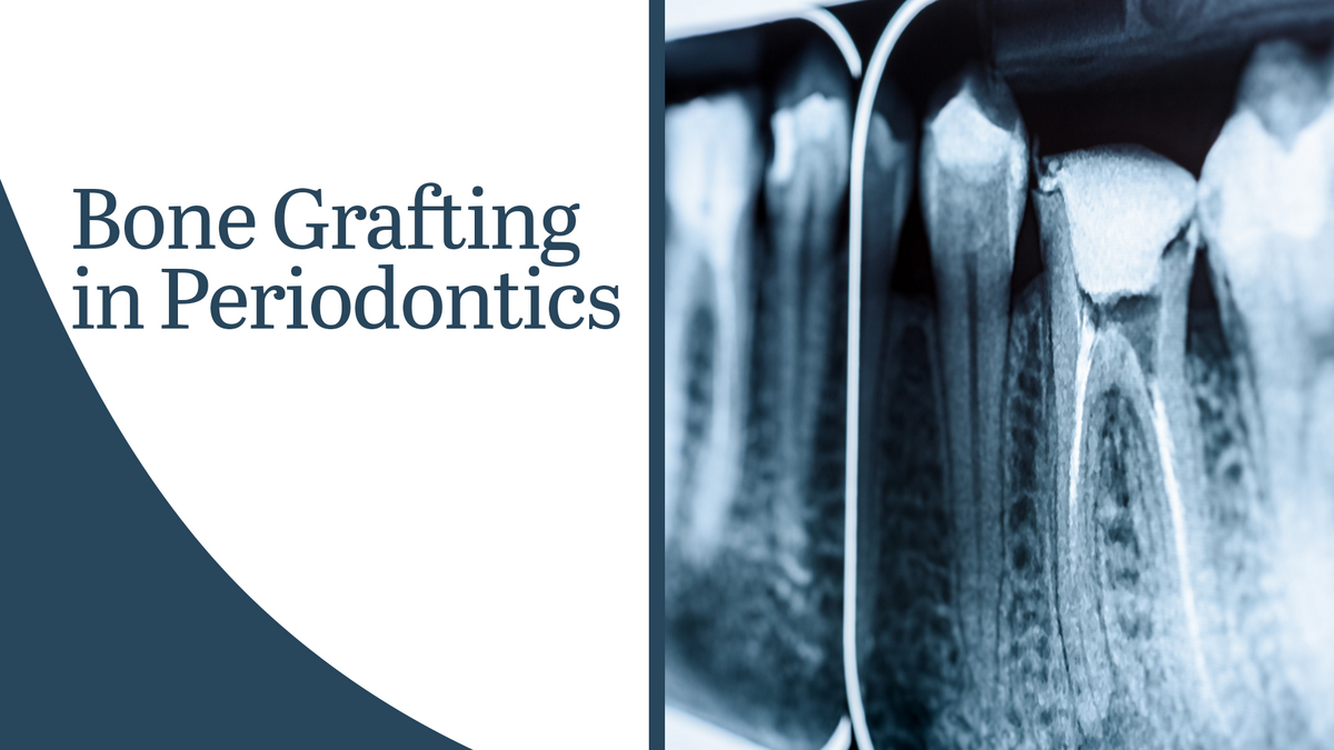 Bone Grafting in Periodontics | Bonomo Periodontics